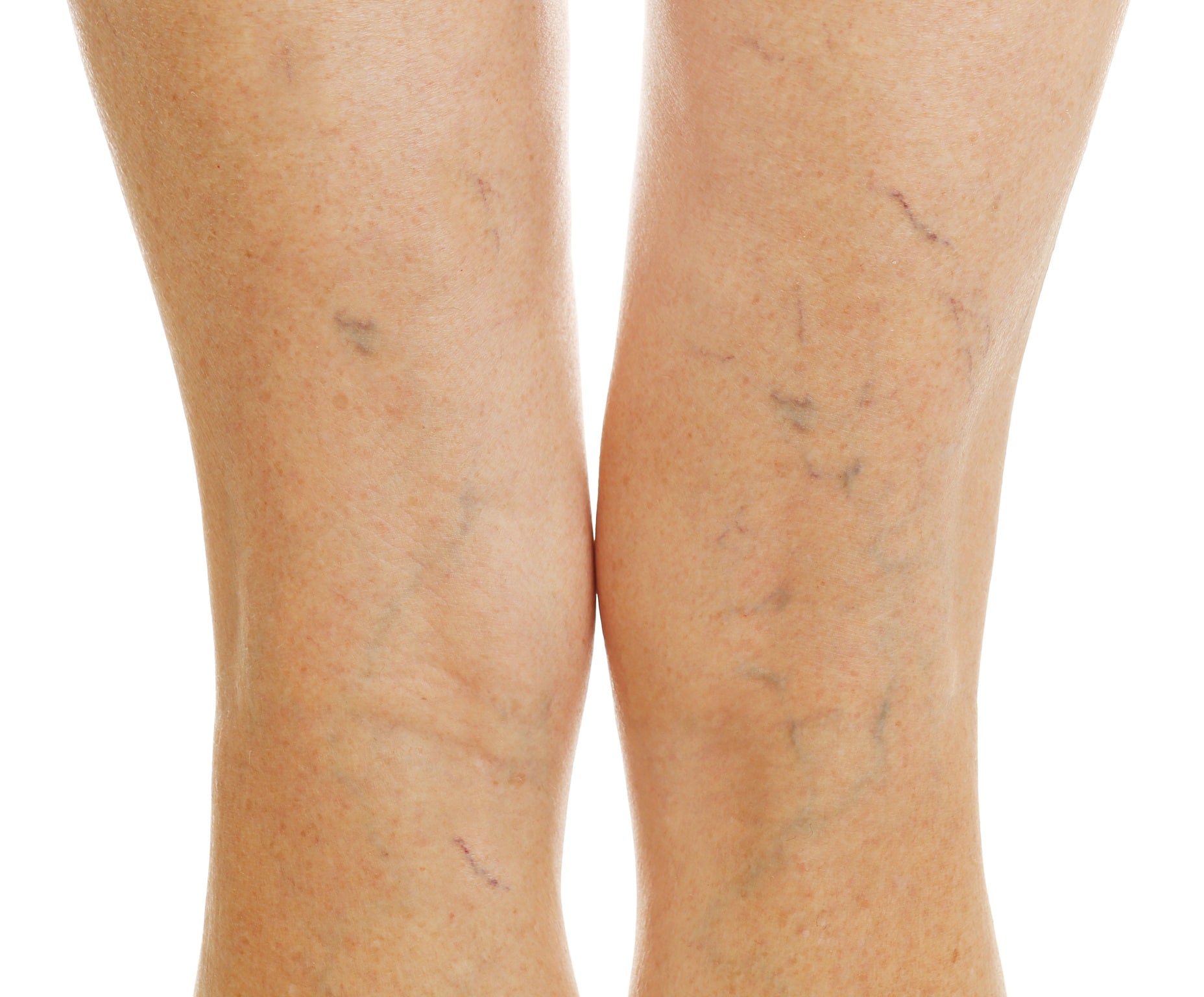 - El Paso Varicose Veins